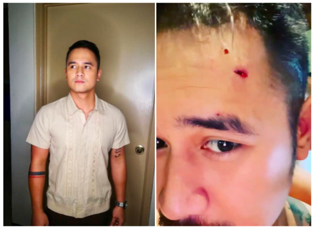 JM de Guzman recalls getting 4 stitches from on-set accident | Inquirer ...