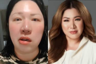 Frenchie Dy suffers third Bell’s palsy attack