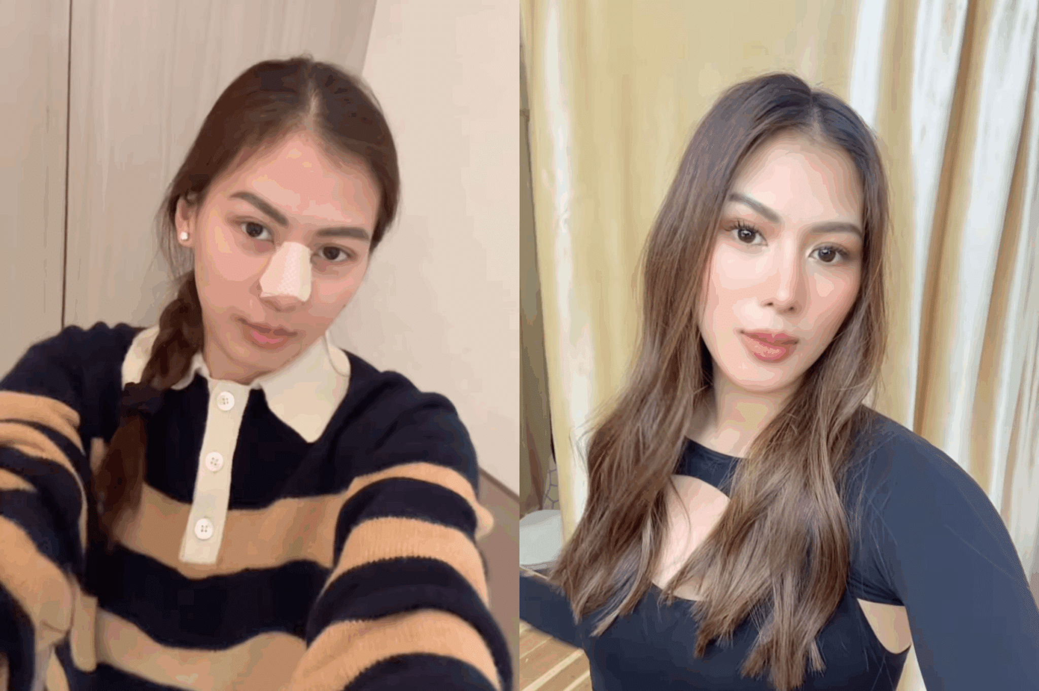 Alex Gonzaga reveals undergoing nose implant removal