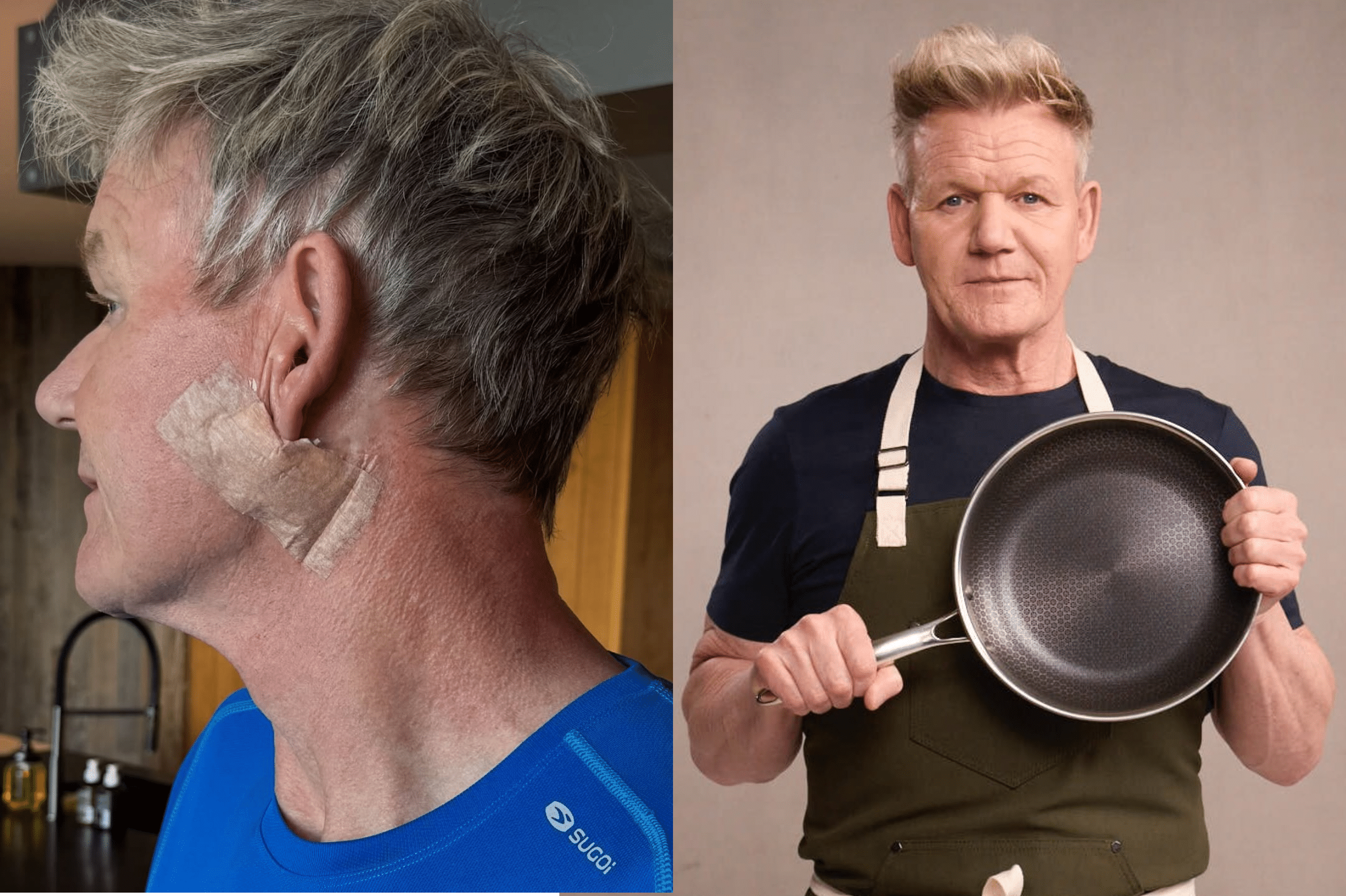 Gordon Ramsay undergoes skin cancer surgery